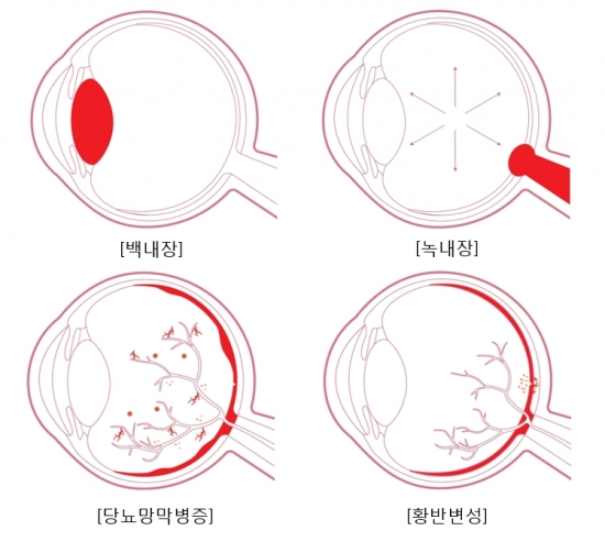 녹내장 황반변성 당뇨망막병증 3대 실명질환 최근 4년 새 급증 국민일보